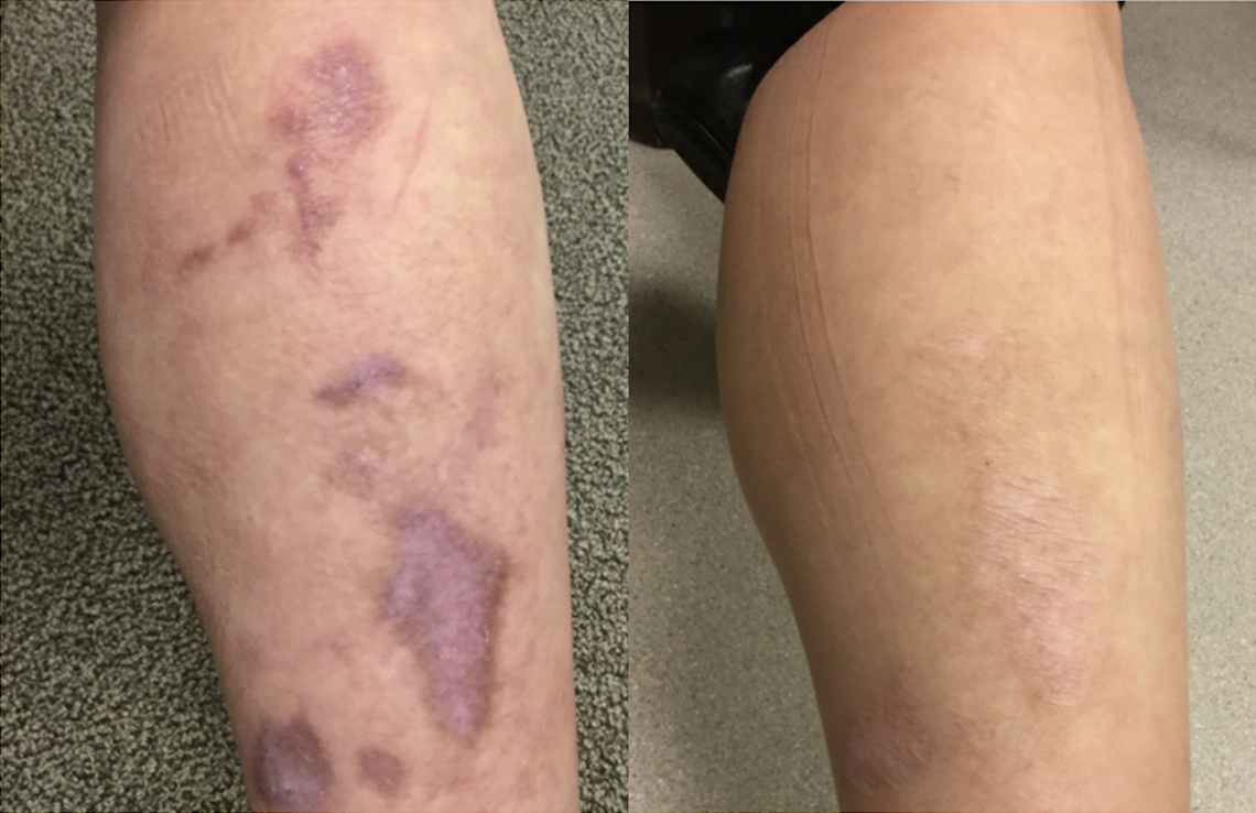 Laser Treatment Of Scars Baylor Medicine